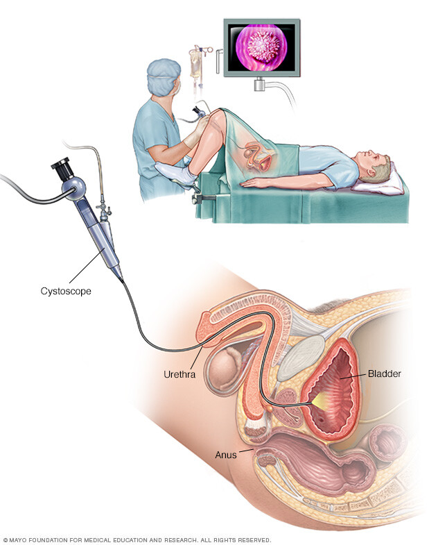 Cystoscopy